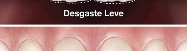 Consecuencias del desgaste dental - Clínica dental Sedaví y Alcudia