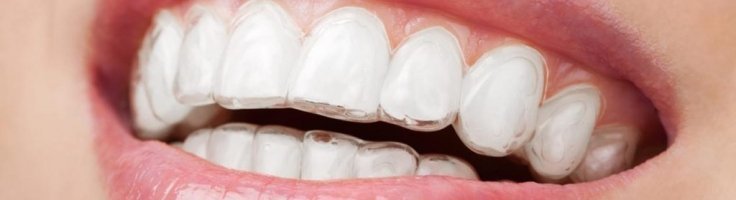 ¿Por qué es importante usar retenedores después de un tratamiento de ...